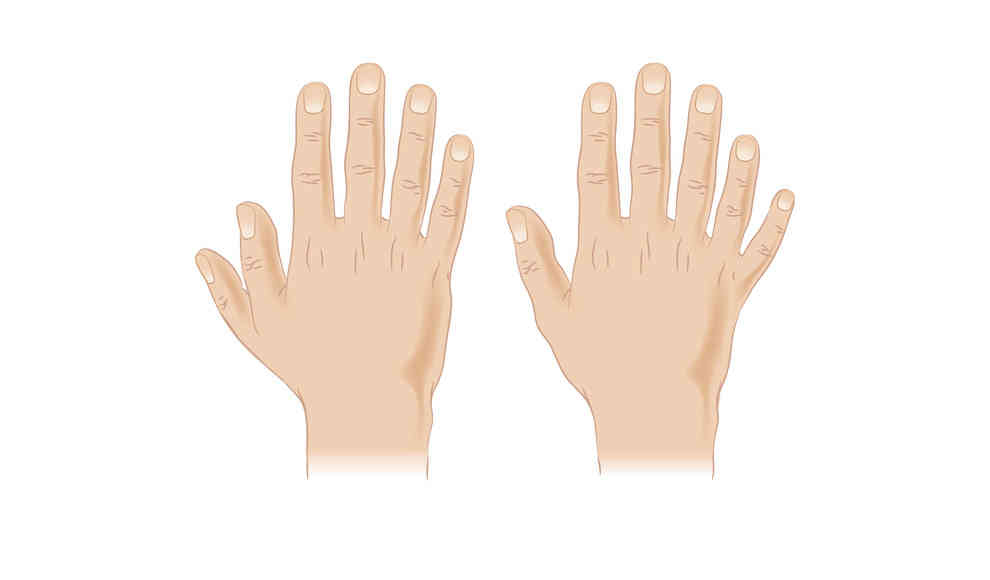 Menschen mit Polydaktylie sind klar im Vorteil