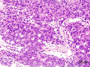 Gen löst Multiple Sklerose aus