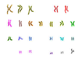 Genie und Wahnsinn besitzen die selbe genetische Grundlage